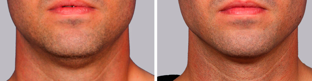 Double Chin Reduction for Men – Absolute Face & Body Medspa