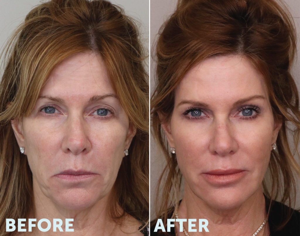 Vsoft Lift Threads – Absolute Face & Body Medspa